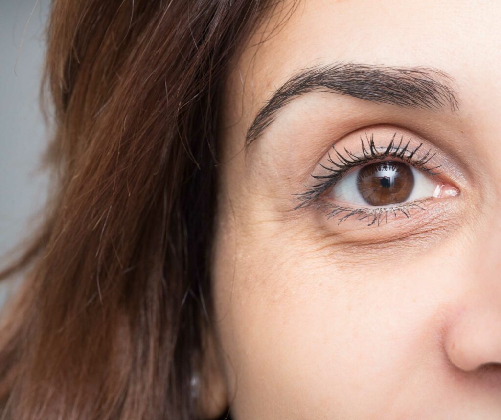 Quels sont les différents types de cernes et comment les traiter ? |Dr ...