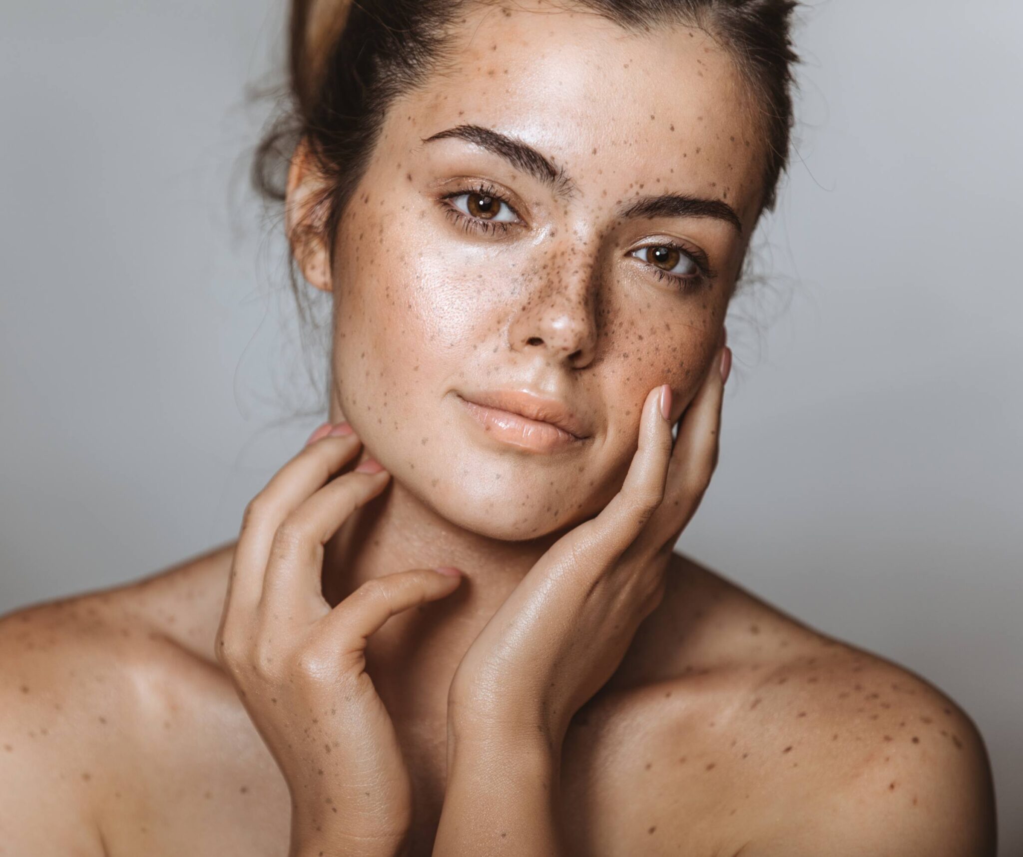 Quels sont les différents types de taches pigmentaires et leur traitement ? |Dr Corinne Pachet ...